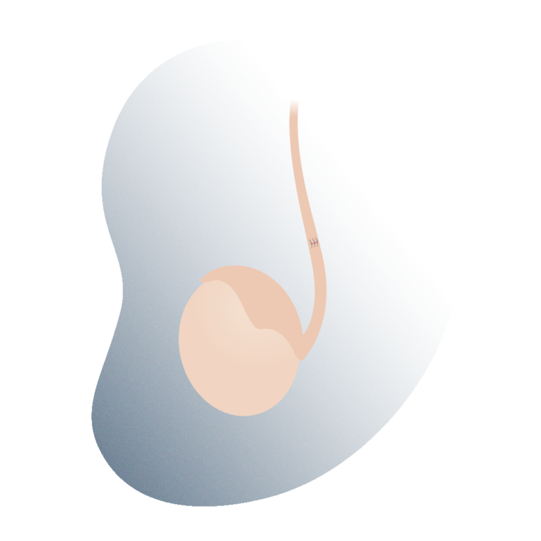 Vasectomy Reversal - Andromedi