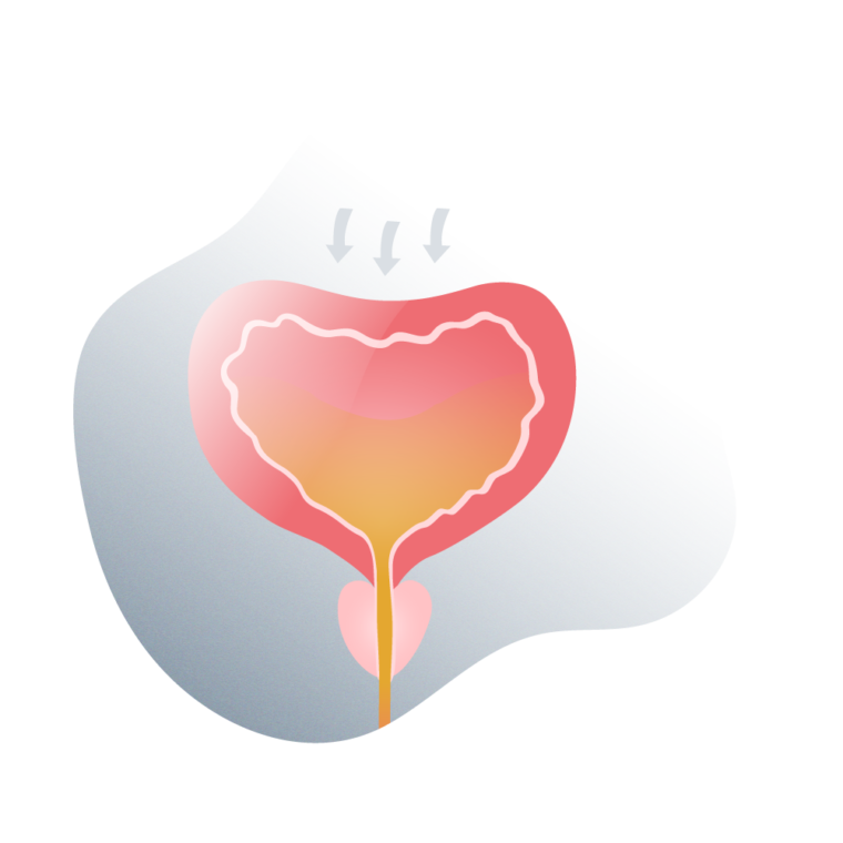 Cirugía de esfínter urinario artificial en hombres