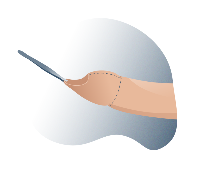 Clínica privada fimosis: Cirugía, precios y resultados